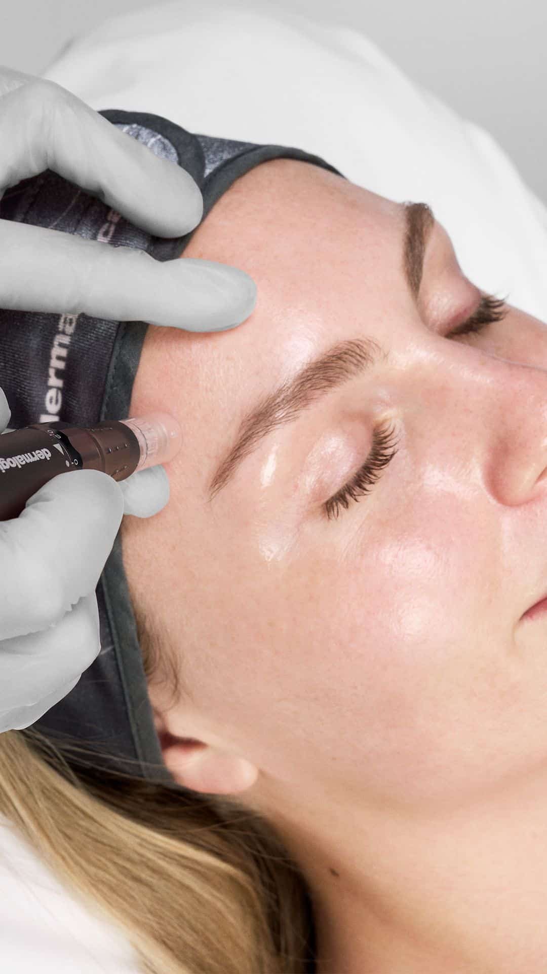 Exo Booster Treatment Cork | Exosome Skin Rejuvenation
